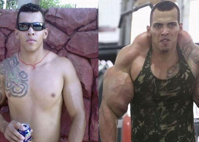 Brasil: casi le amputan los brazos a Hulk brasileño | TN8.ni